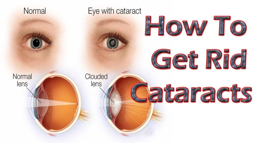 What is Eye Cataracts - Prevention, Sign of Symptoms, Treatment ...